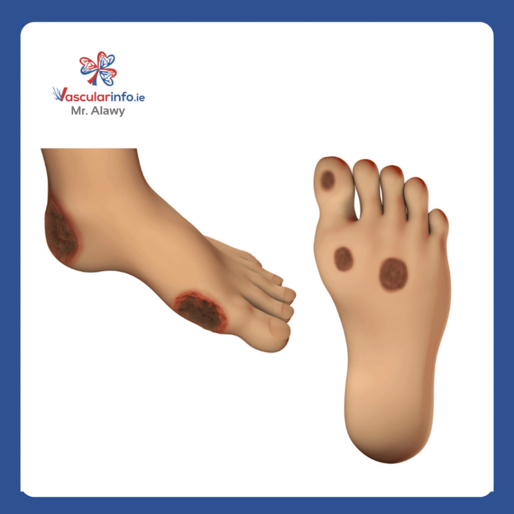 Diabetic Foot - Vascular Info